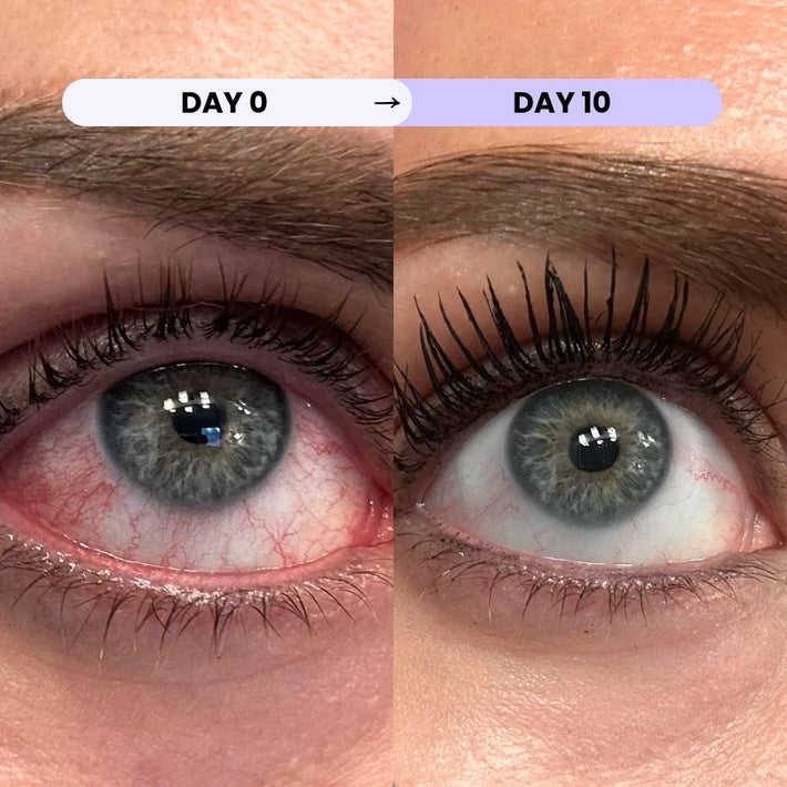 REALief™ Dry Eye Relief Eyelid Wipes—Wipe Away Eye Dryness! | EYEMOS®